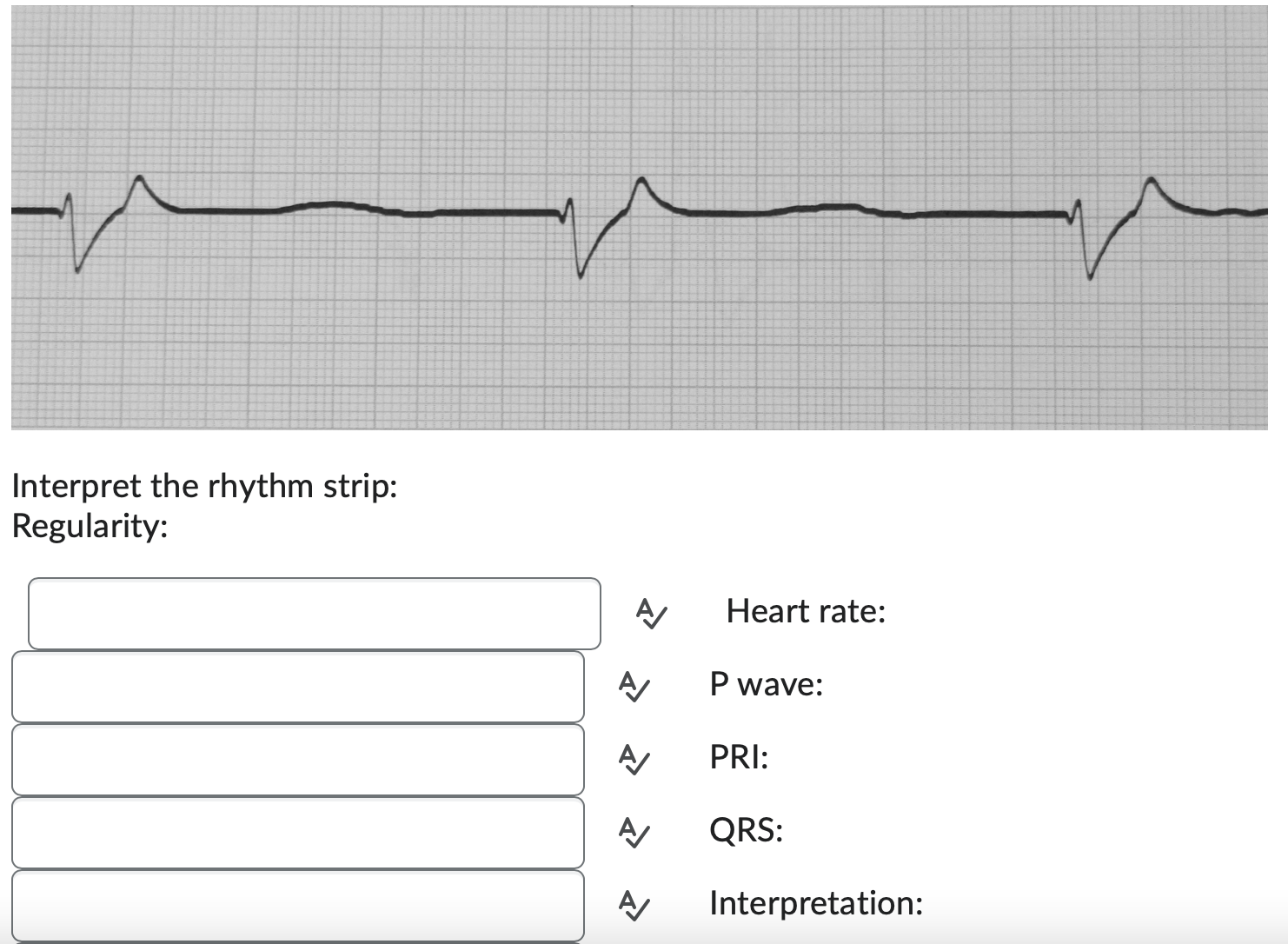 Solved Interpret the rhythm strip:Regularity:Heart rate:P | Chegg.com