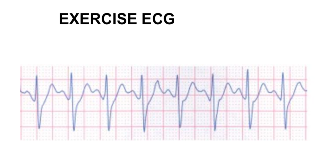 Solved Based on the attached EKG provided; Calculate the | Chegg.com