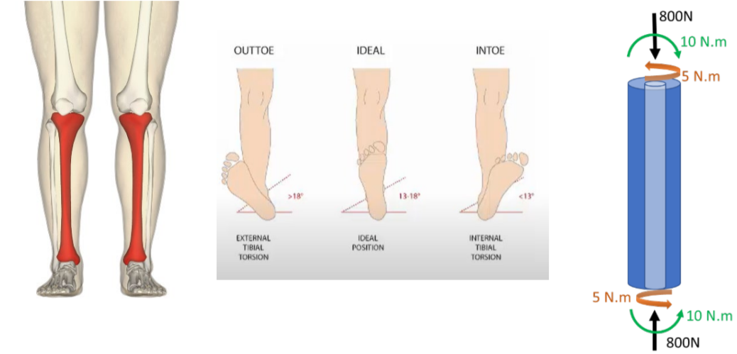 External Tibial Torsion