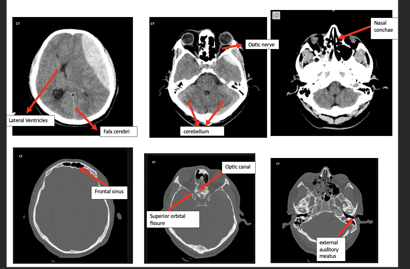 A large biconvex epidural haematoma in the left | Chegg.com