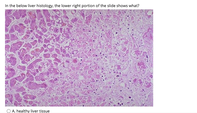 In the below liver histology, the lower right portion | Chegg.com