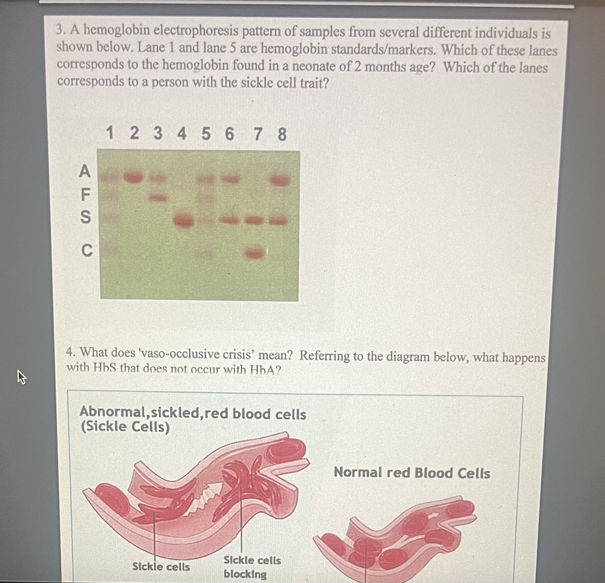 Solved 3. A hemoglobin electrophoresis pattern of samples | Chegg.com