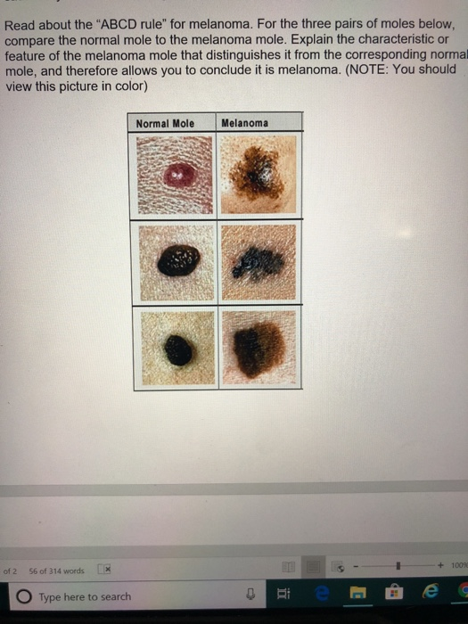 Solved Read about the "ABCD rule" for melanoma. For the | Chegg.com