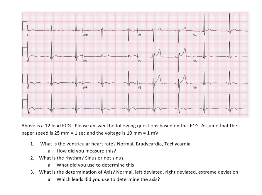 Solved w AVR V1 V4 aVL V2 V5 h aVF V3 V6 Above is a 12 lead | Chegg.com