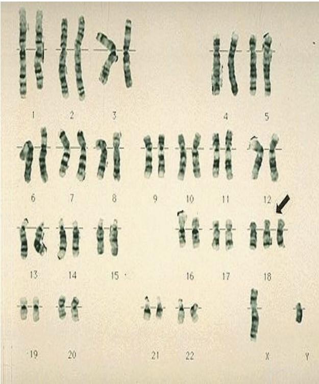 Solved With the following karyotype report provide the | Chegg.com