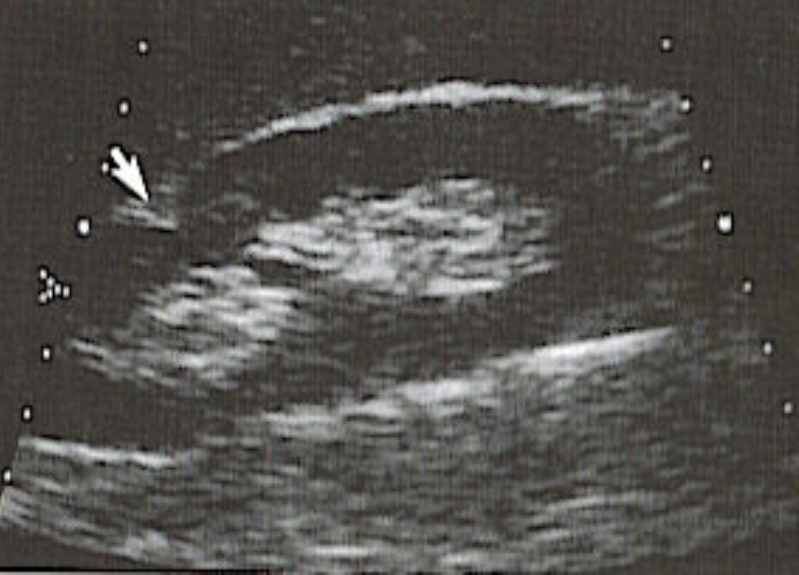 Junctional Parenchymal Defect