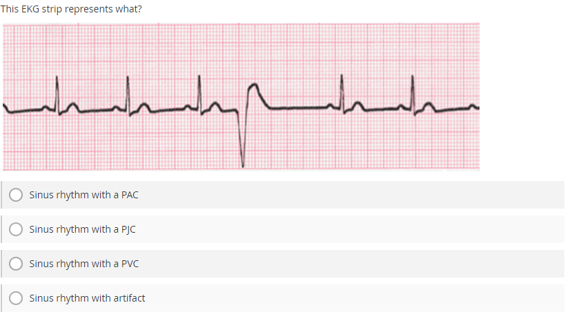 Solved This Ekg Strip Represents What Sinus Rhythm With A