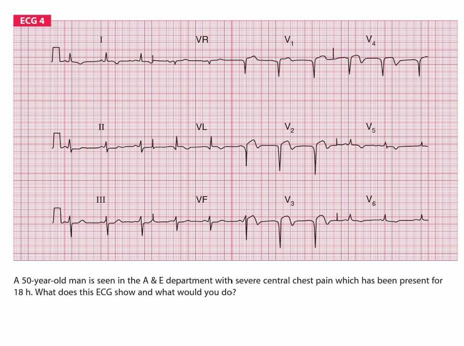 Solved ECG 4 VR у. гу, Пл mehr IT пра ІІ VL V, V. МЕН т Ш VE | Chegg.com