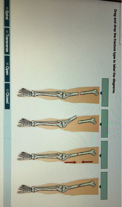 Solved Drag and drop the fracture type to label the | Chegg.com