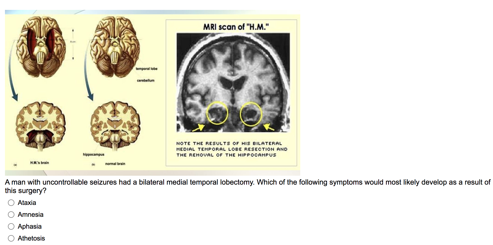 Solved MRI scan of "H.M." temporal lobe cerebellum NOTE THE | Chegg.com