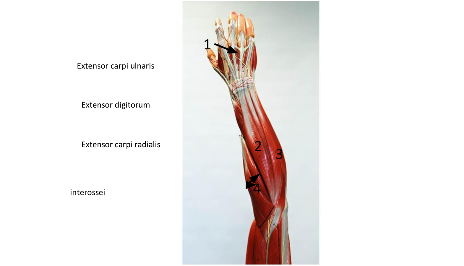 Solved 1 Extensor carpi ulnaris Extensor digitorum Extensor | Chegg.com