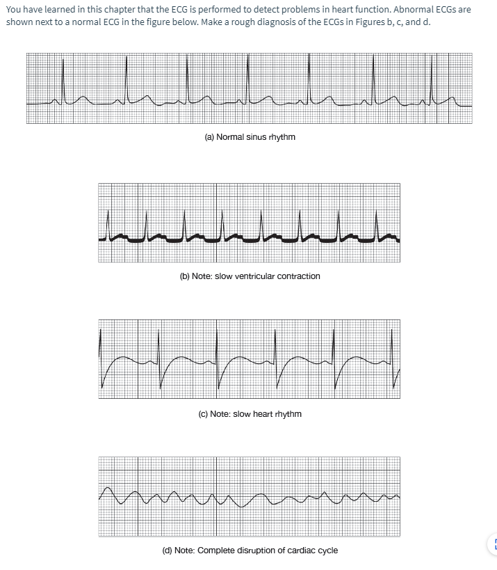 Solved You have learned in this chapter that the ECG is | Chegg.com