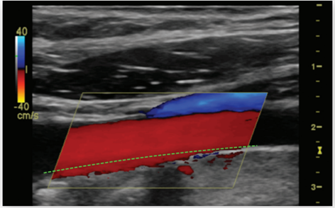What is the color doppler artifact called in the | Chegg.com