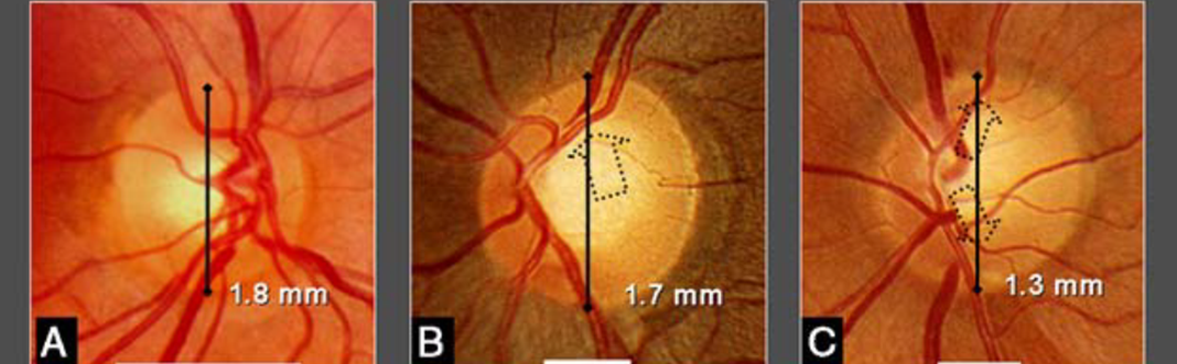 Solved For the following six images of the optic disc (a to | Chegg.com