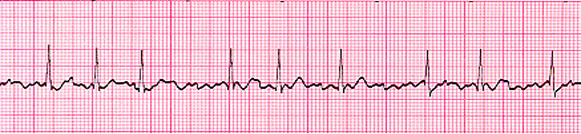 Solved What is the rate, rhythm, PRI, QRSI, and | Chegg.com