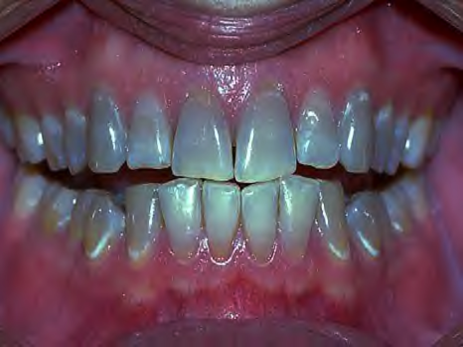 Endogenous Staining Of Teeth