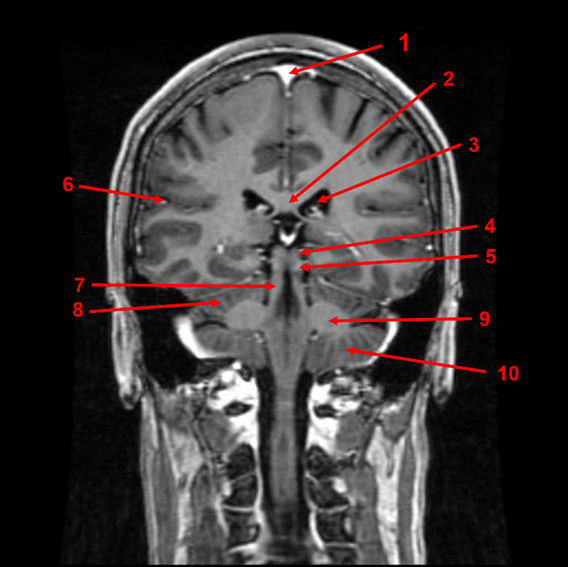 Label the 5 structures indicated in the MRI | Chegg.com