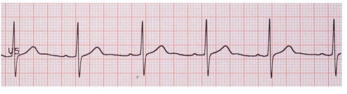 Solved Recall that the RR interval is the time between the | Chegg.com