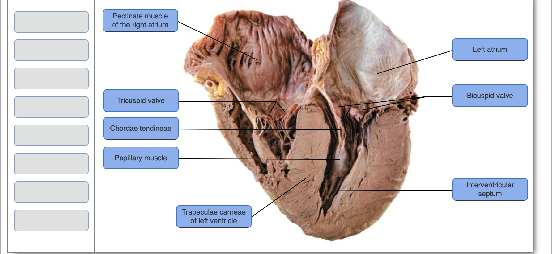 Trabeculae Carneae Vs Papillary Muscle