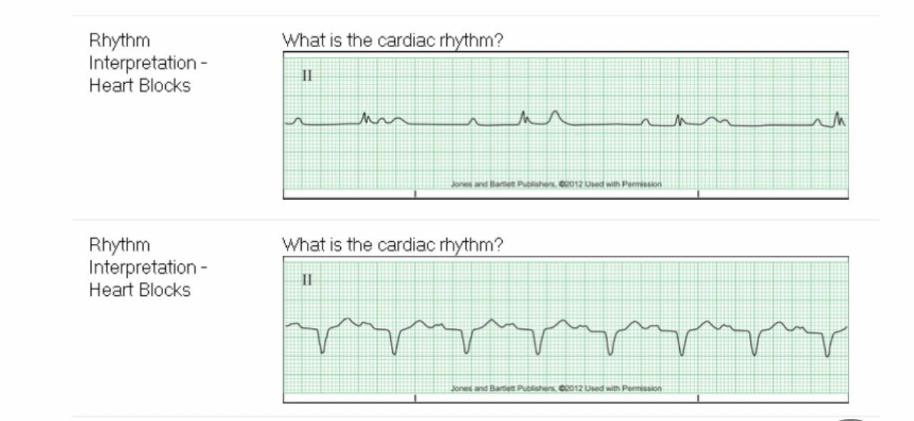 Solved Rhythm Interpretation - Heart Blocks Rhythm | Chegg.com