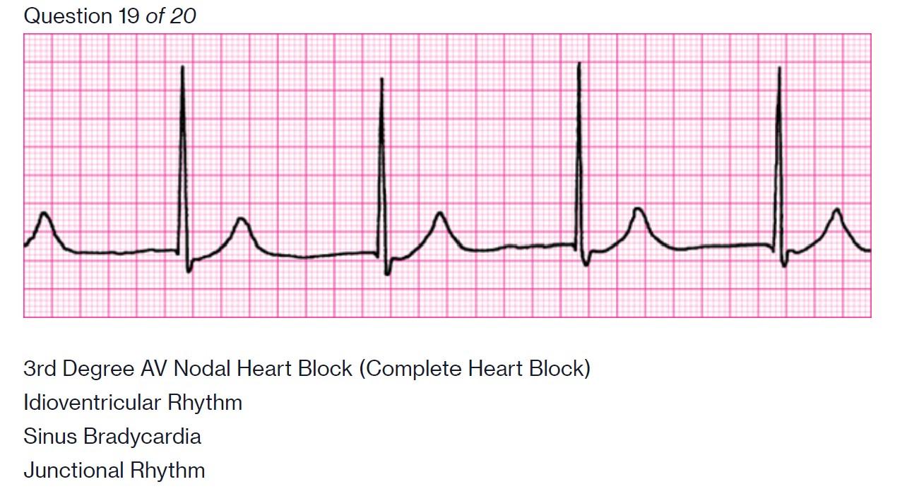 Solved Question 19 of 20 who a 3rd Degree AV Nodal Heart | Chegg.com