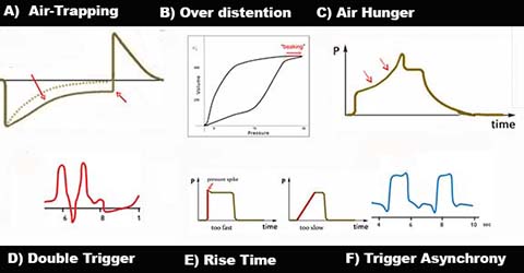 Solved Using a BiPAP mode on NIV ventilator, the following | Chegg.com