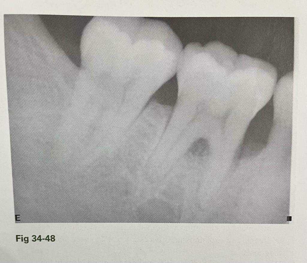 Identify the pattern of, severity of bone loss, and | Chegg.com