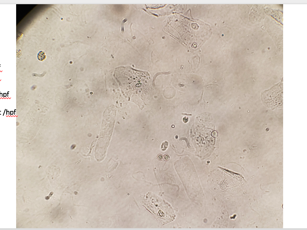 Example: 25-30 RBCs/hpf 1–2 WBCs/hof 1-2 RTEs/hpf | Chegg.com