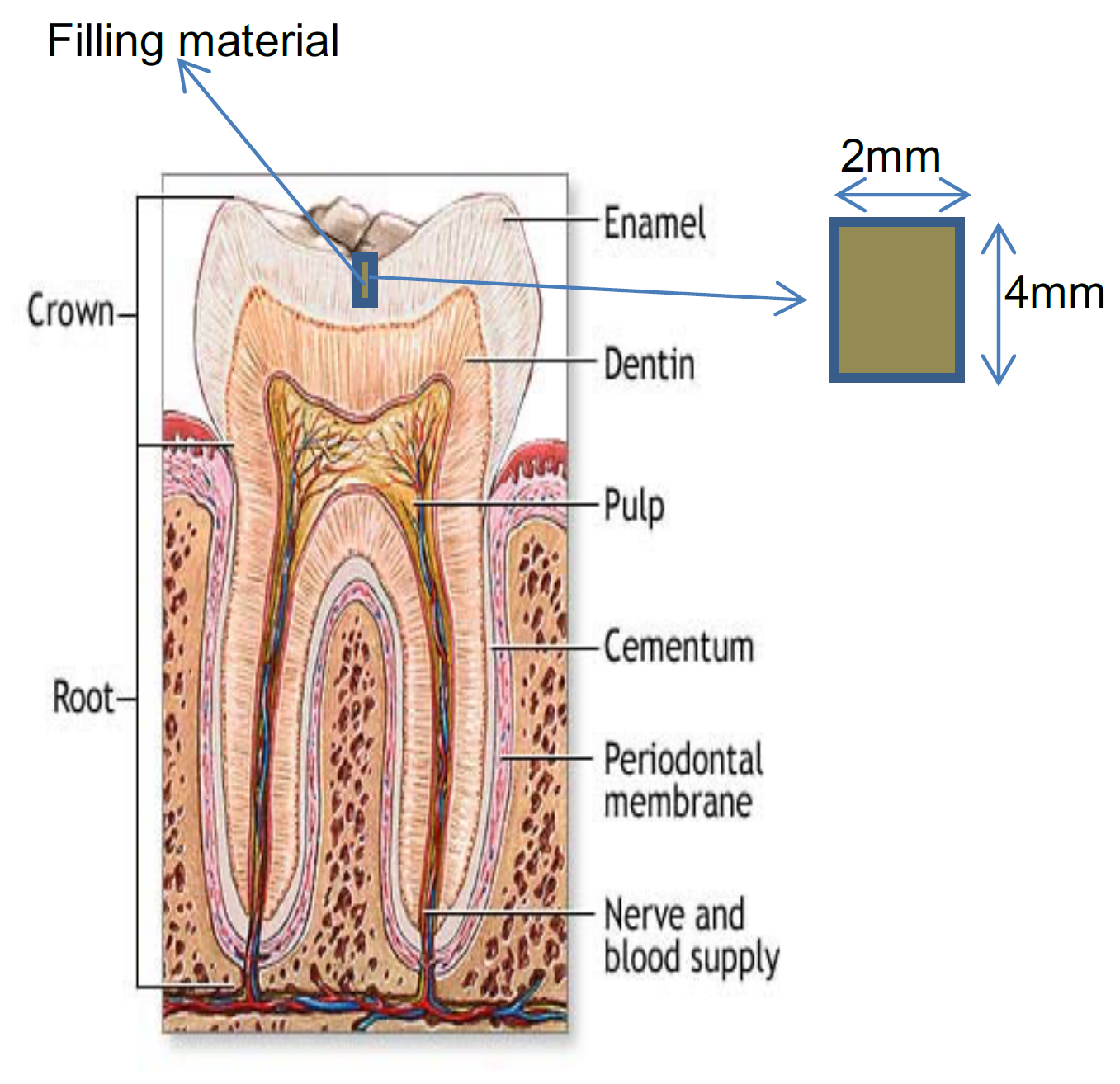 Solved Dental filling materials can readily experience a | Chegg.com