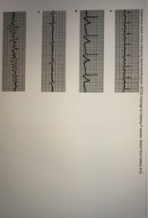 Solved m (ECG) tracings is missing P waves. Select from | Chegg.com