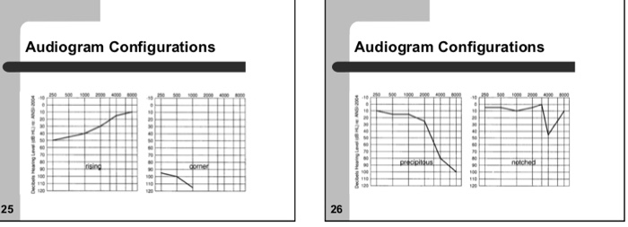 Tympanic Membrane Perforation Audiogram