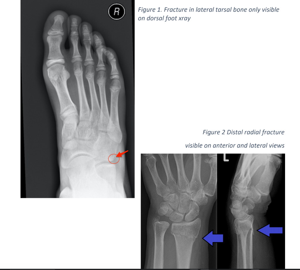 Solved R Figure 1. Fracture in lateral tarsal bone only | Chegg.com