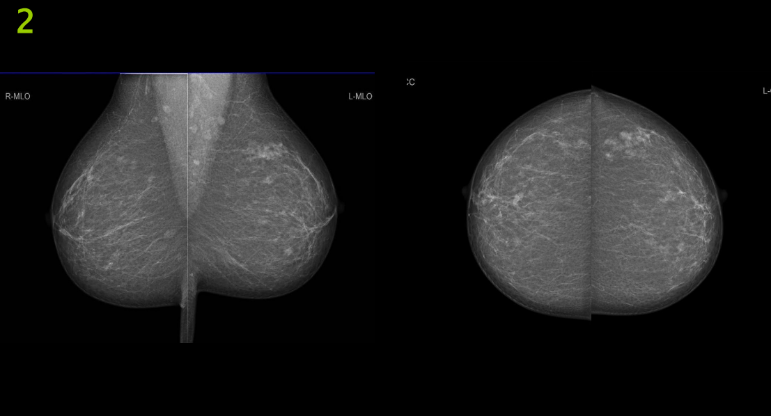 Mammography PGMI evaluation hi can i get help | Chegg.com
