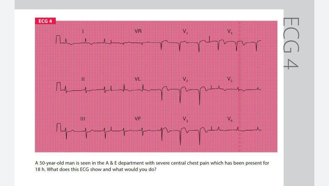 Solved ECG 4 VR V. V M m ECG 4 II V. V. re L HI! VE V. V | Chegg.com