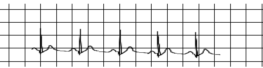 Above you will find a normal Lead II EKG trace. | Chegg.com