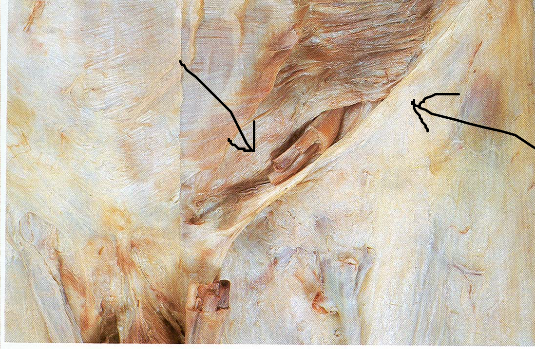 Lacunar Ligament Cadaver