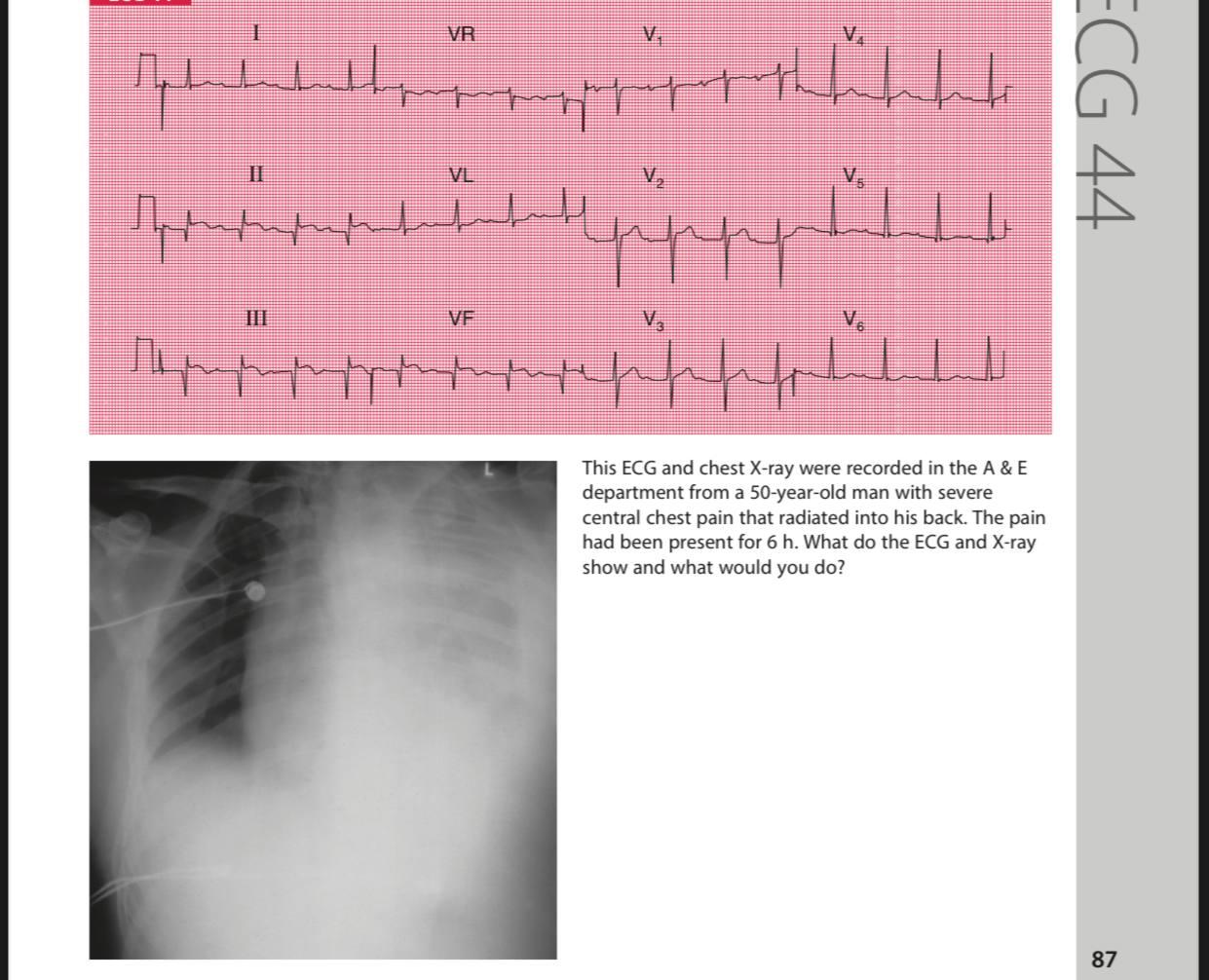 Solved VR V. ECG 44 VL V. Jeta tothhhh ynyt tytta VE This | Chegg.com