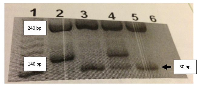 Solved PCR-RFLP analysis of exon 4 of the HFE gene from a | Chegg.com