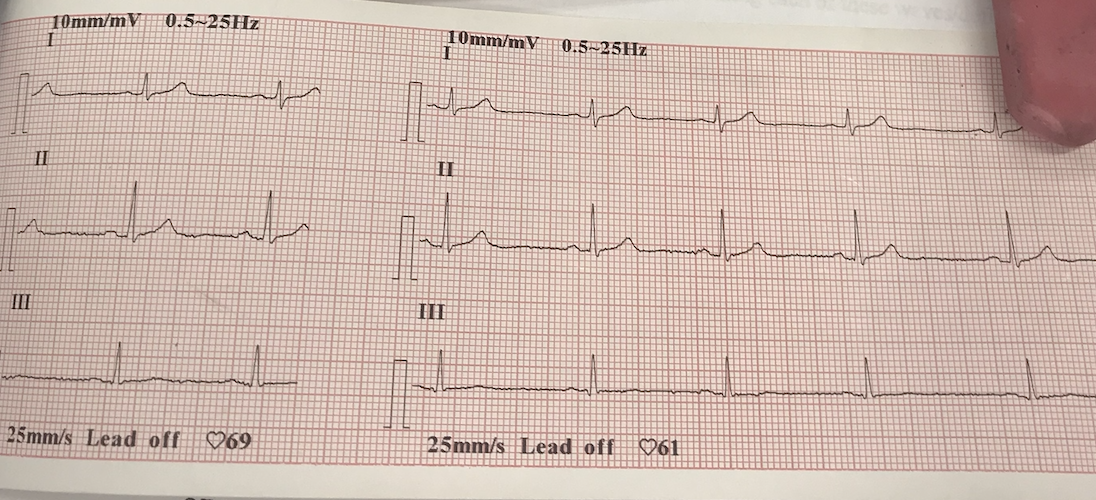 Solved 10mm/mV 0.5-25Hz 10mm/my 0.5-251 25mm/s Lead off 69 | Chegg.com