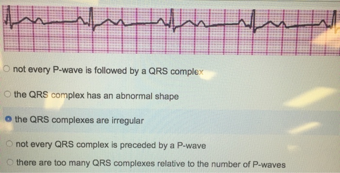 Solved O not every P-wave is followed by a QRS complex the | Chegg.com