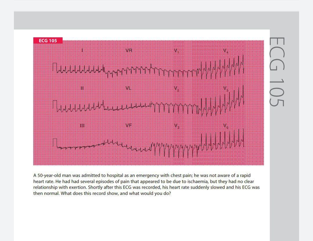 Solved ECG 105 I VR V. V wwert www.torty ECG 105 TI VU V. | | Chegg.com