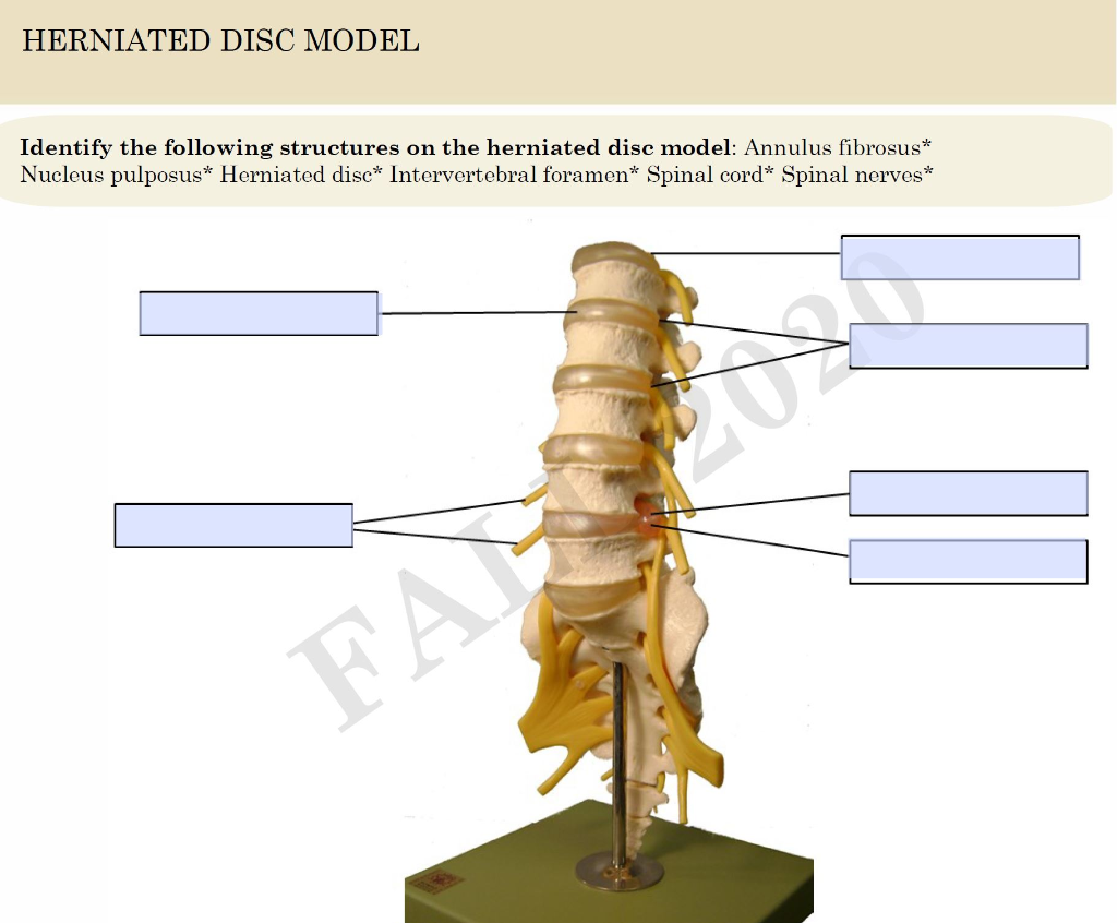 Solved HERNIATED DISC MODEL Identify the following | Chegg.com