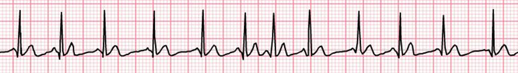 Solved identify the rhythm of this EKG. atrial flutter. | Chegg.com