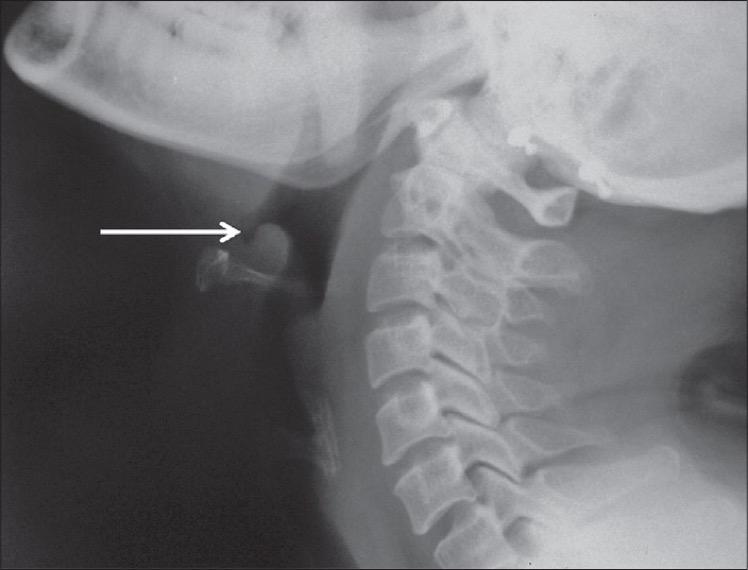 Normal Epiglottis Vs Thumbprint Sign