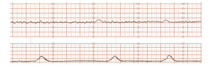 Are There Accelerations Or Decelerations Present On 7627