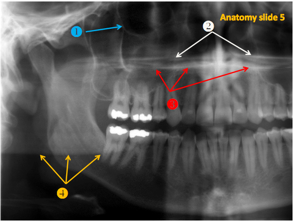 Pterygomaxillary Fissure Radiograph