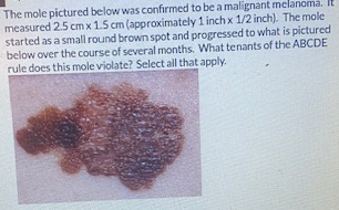 Solved The mole pictured below was confirmed to be a | Chegg.com