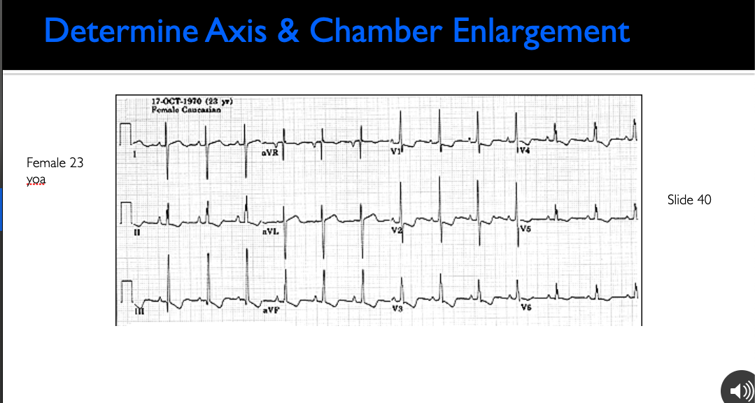 Solved Determine Axis & Atrial Enlargement Slide 14 A VA MI | Chegg.com