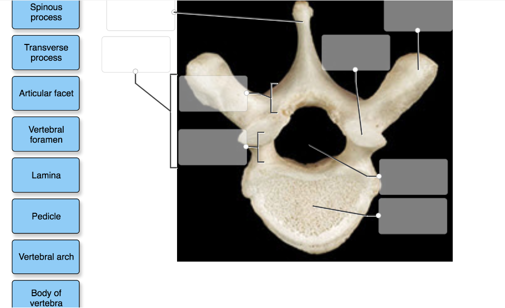 Solved Body of mandible Mandibular notch Ramus of mandible | Chegg.com