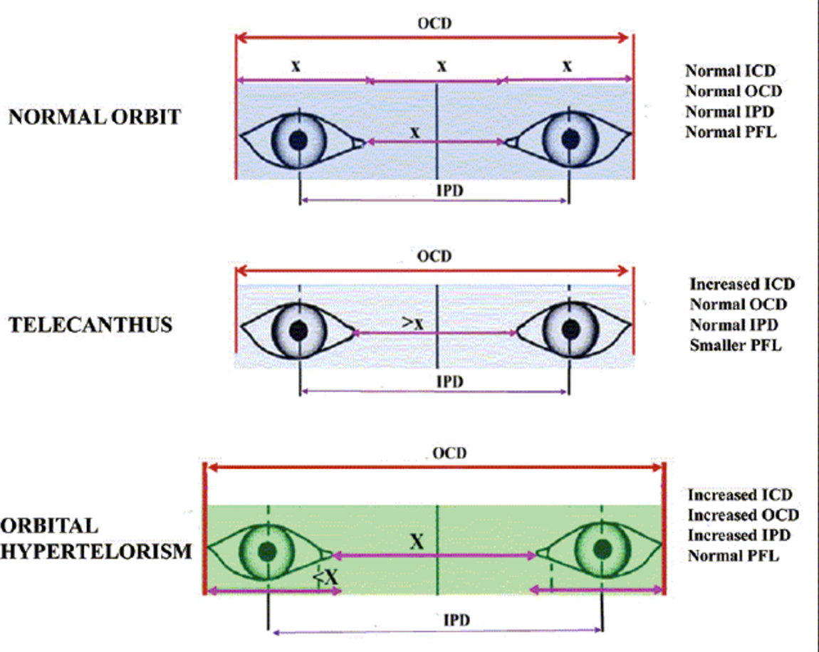 Traumatic Telecanthus